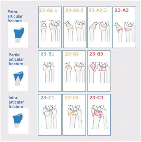 Ao Distal Radius Fracture Classification My Xxx Hot Girl