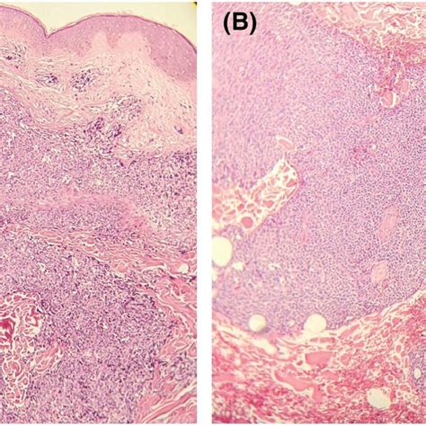 A Hyperpigmented Patches On Face And Upper Trunk B Violaceous