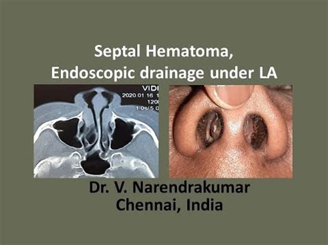 How To Drain Septal Hematoma