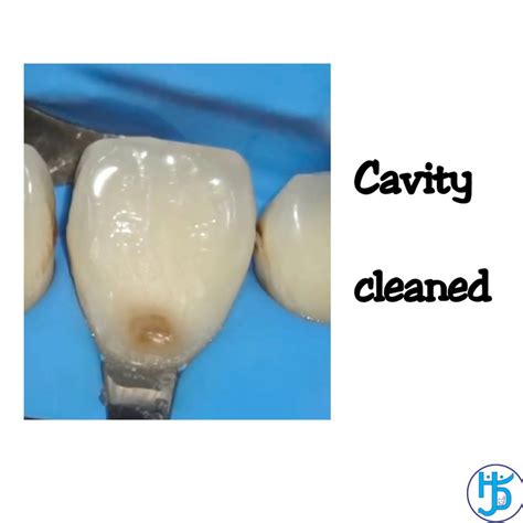 Single Visit Tooth Build Up And Esthetic Rehabilitation Of Carious