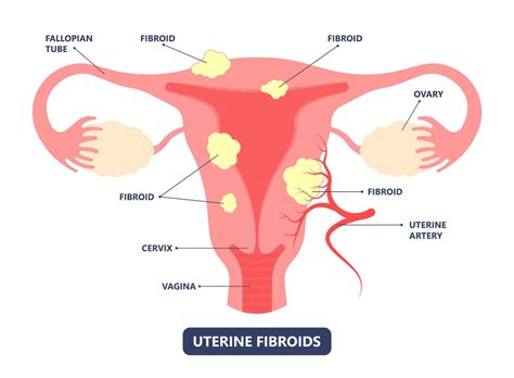 Endometriosis Vs Fibroids American Fibroid Centers