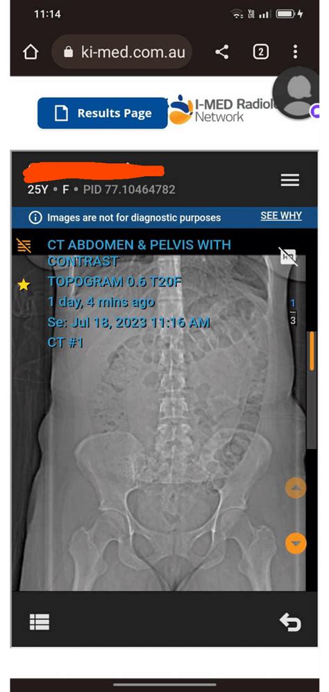 How Does The Lower Intestine End Up In The Chest Ranatomy