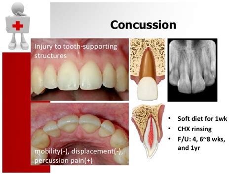 Dental Trauma Guide Primary Teeth Concussion At Jane Mcgary Blog
