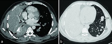 Role Of Percutaneous Computed Tomography Guided Lung Biopsy In Non Resolving Consolidation And