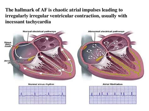 Atrial Fib And Flutter