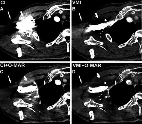 Reduction Of Artifacts From Contrast Media In Spectral Detector Ct By Combined Use Of Virtual