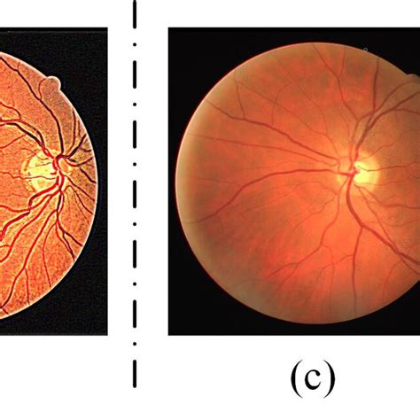 examples of fundus images before and after preprocessing a example