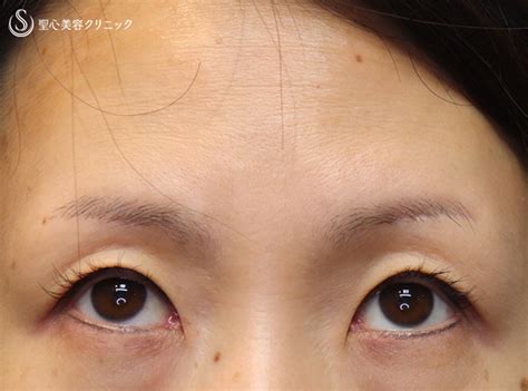 40代女性10年前の私に眉下切開埋没法右目のみ1年後 症例写真 美容整形美容外科なら聖心美容クリニック