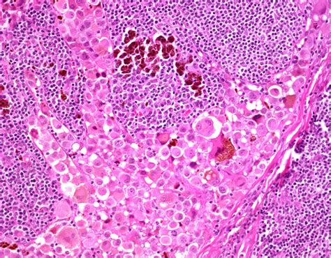 Lymph Node Metastasis In Melanoma Light Micrograph Stock Image C051 1613 Science Photo