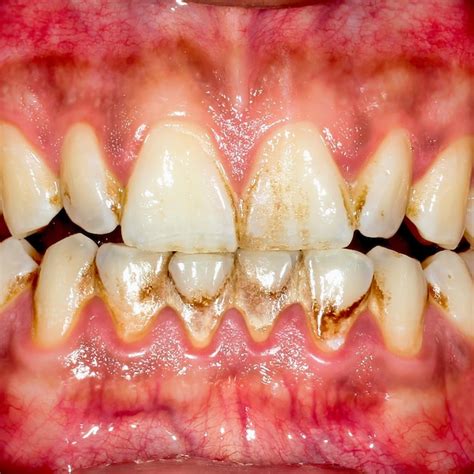 Premium Photo Closeup Of Teeth With Brown Stains