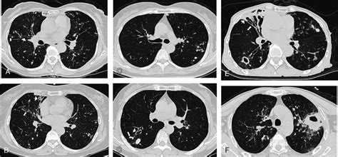 Computed Tomography Comparative Analysis Of Nontuberculous M Journal Of Computer Assisted