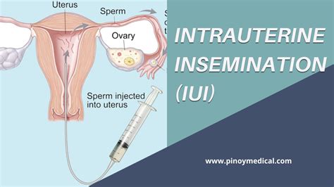 Intrauterine Insemination Price In The Philippines 2026 — Pinoymedical