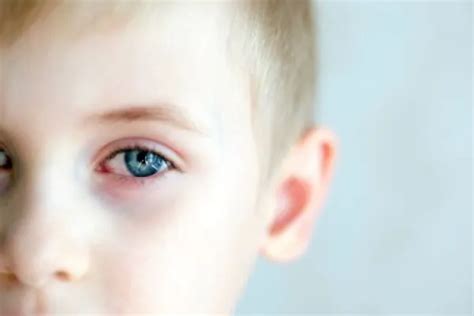 Clear Up Conjunctivitis Coding Practices Pediatric Coding