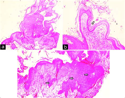 A Lesional Tissue H And E ×4 B Keratin Plugging H And E ×10