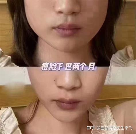 李飞抗衰 如何让自己的面部轮廓更加的清晰呢 知乎