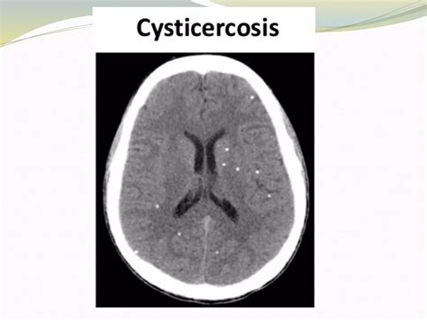Physiological And Pathological Calcification Of Brain Pptx