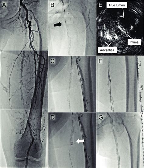 A Angiography Revealed A Cto With Heavy Calcification In The Left Sfa