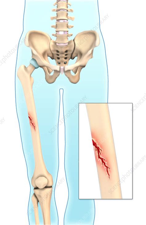 Greenstick Bone Fracture Illustration Stock Image C027 7179 Science Photo Library