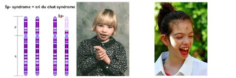 Cri Du Chat Syndrome Symptoms