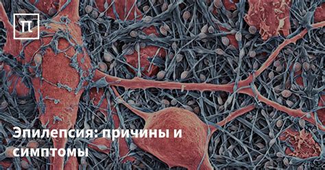 Эпилепсия: причины и симптомы — все самое интересное на ПостНауке