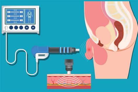 Shockwave Therapy For Erectile Dysfuntion The Forbury Clinic