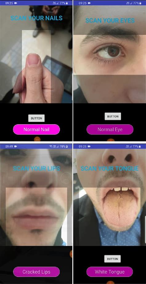 Vitamin Deficiency Detection Using Image Processing And Neural Network Semantic Scholar