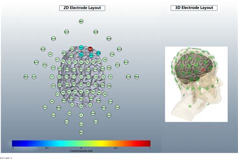 Figure 2 From A Randomized Sham Controlled Trial Of High Definition Transcranial Direct Current