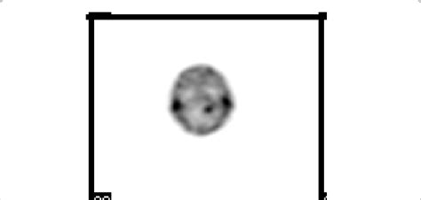 Octreotide Scan Demonstrate Increased Uptake At The Left Medulla Download Scientific Diagram