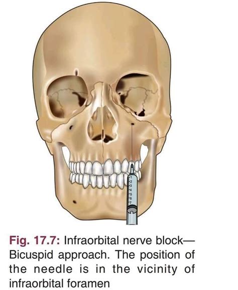 Infraorbital Nerve Block Location Of The Infraorbital Foramen With