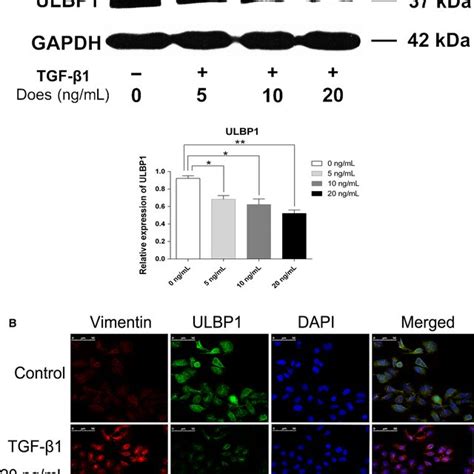 Three Epithelial‐mesenchymal Transition Subtypes Of Circulating Tumor