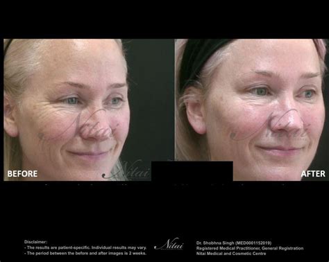 Crows Feet Wrinkles Archives Laser Skin Treatment Clinic Melbourne