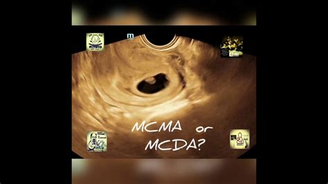 Mcma Twins Or Mcda Twins Youtube