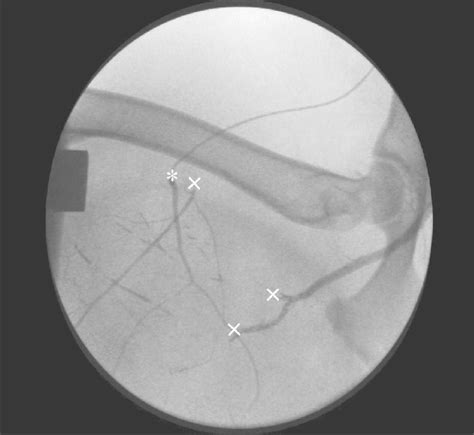 Pre Embolization Super Selective Arteriography Of The Second Collateral