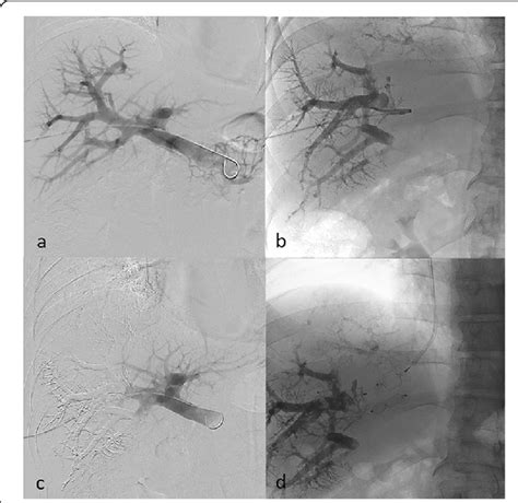 A D Combined Embolization Of The Portal Vein And Then Right Hepatic