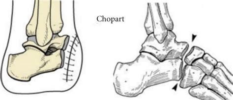 Fatigue Characteristics And Numerical Modelling Prosthetic For Chopart