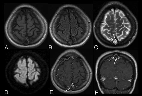 Arachnoid Granulations Histology