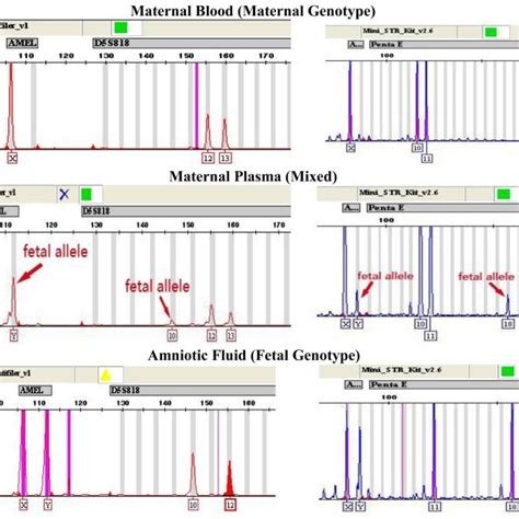 Y Str Genotyping Of Dna From Maternal Plasma With A Male Fetus 16 Download Scientific Diagram