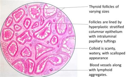 Toxic Goiter Pathology Made Simple
