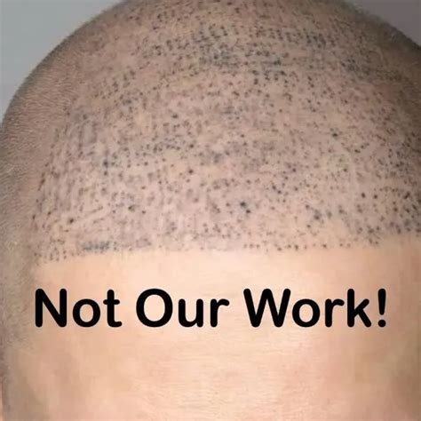 Scalp Micropigmentation Regrets Causes And What To Do About Them Scalp Micropigmentation Regrets Causes And What To Do About Them