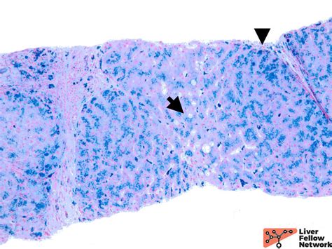 Pathology Pearls Hereditary Hemochromatosis Aasld