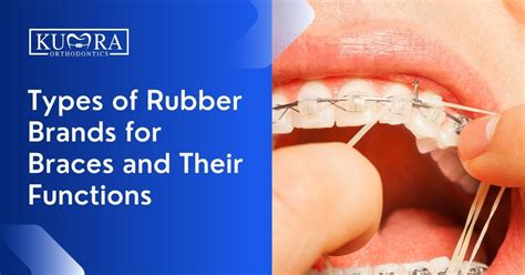Types Of Rubber Brands For Braces And Their Functions Kumra Orthodontics