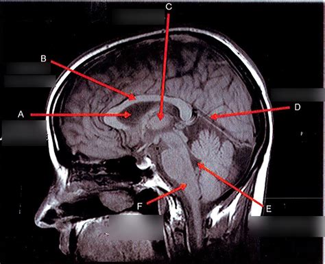 T1 Sagittal Brain Diagram Quizlet