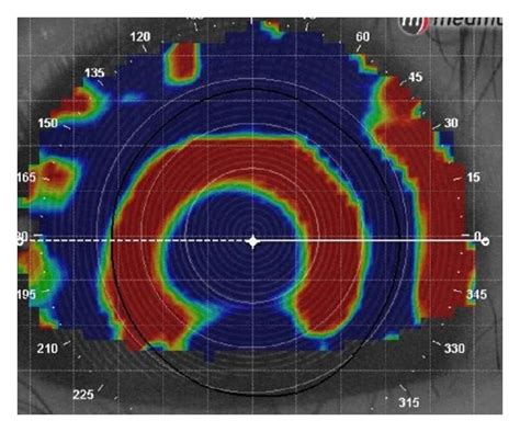 Image Of An Incomplete “inversion Arc” A The Incomplete Acquisition Download Scientific