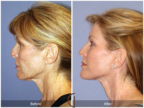 Patient 343720 Facelift 60s Before And After Photos Dr Kevin Sadati