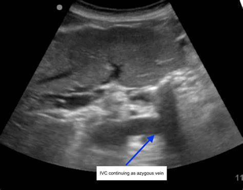 Missing Inferior Vena Cava On Pocus A Case Of Left Sided Ivc With