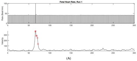 Reactive Fetal Heart Rate Tracing