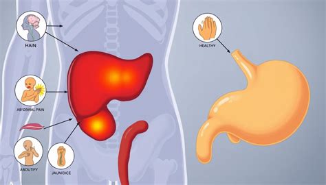 Gallbladder Cancer Symptoms Diagnosis And Treatment