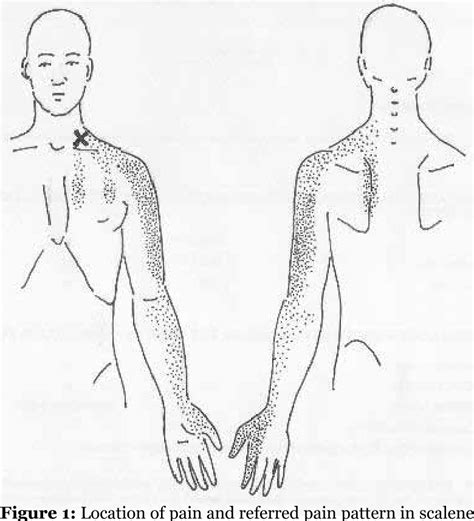 Scalene Muscles Trigger Points