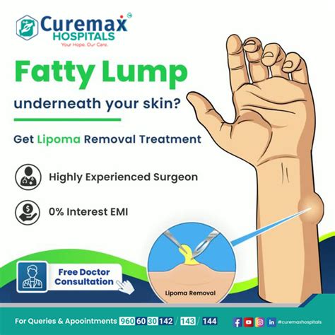Lipoma Treatment Guidance At Multispecialty Hospital In Bangalore