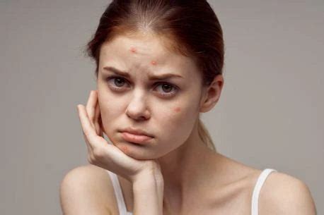 Pustules Acne Images Pictures Photo Gallery Of Skin Pictures